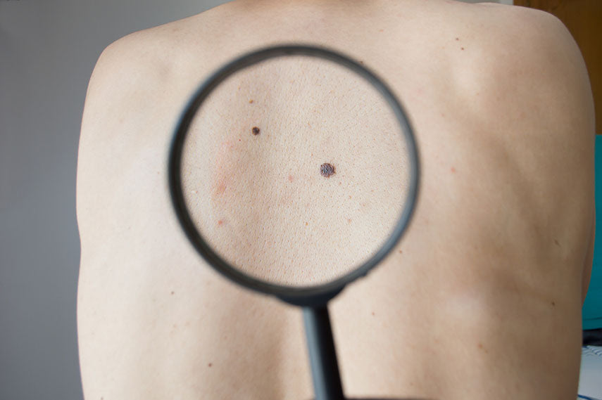What Causes Skin Cancer? – Tiege Hanley