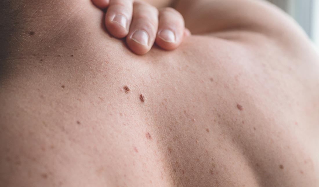 Worried About Age Spots? 5 Ways Men Can Reduce or Remove Them – Tiege ...