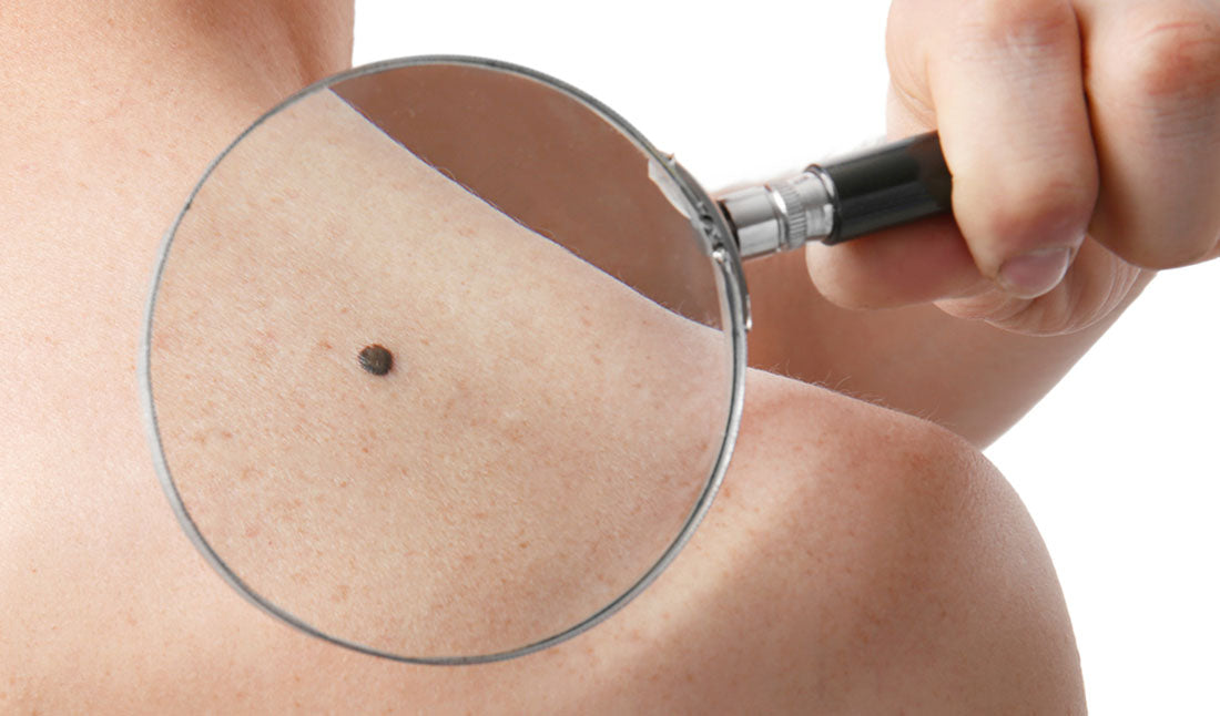 Itchy Moles: Symptoms, Causes and Treatment – Tiege Hanley